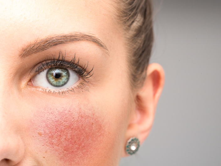 Couperose et rosacée : traitement au laser à Lausanne