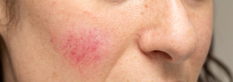 Couperose et rosacée : traitement au laser à Lausanne