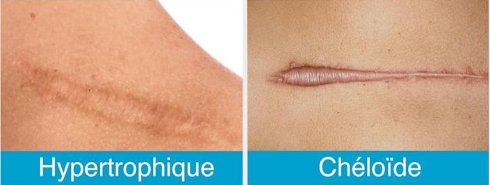 Comment traiter une cicatrice chéloïde